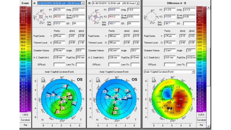 Topography Guided Laser Surface Ablation & Collagen Cross Linking for ...
