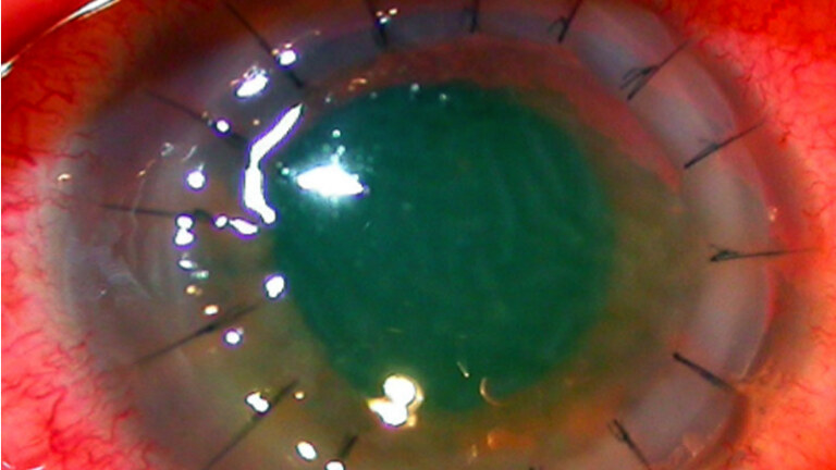 Corneal Infection - Scedosporium Prolificans – Envision Eye Centre